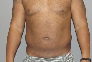 Liposuction Myths: Debunked | Richmond, VA | Lewis Plastic Surgery